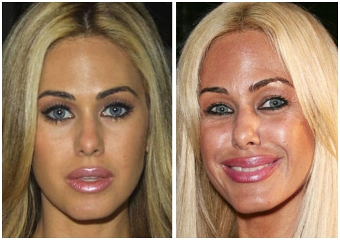 Shocking Transformations Revealed Celebrity Before And After Plastic ...